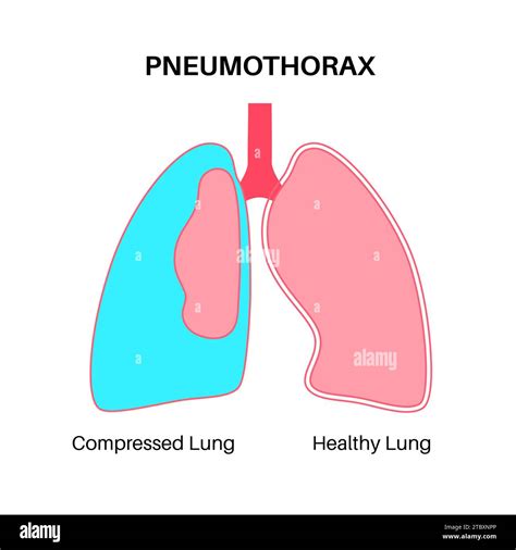 Pneumothorax Collapsed Lung Hi Res Stock Photography And Images Alamy