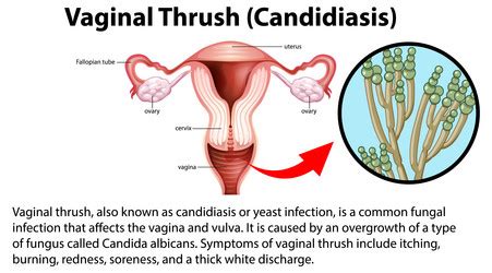Vaginal Thrush During Pregnancy Infographic Vector Image