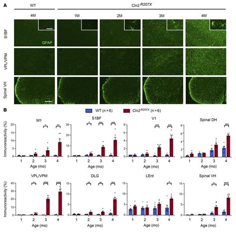 Jci Gene Therapy Ameliorates Spontaneous Seizures Associated With