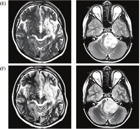 the proposed and existing enhancement models results on brain mri a