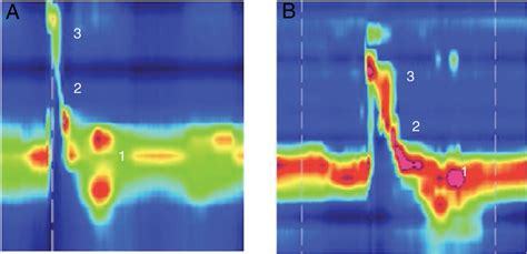 Example Of High Resolution Manometry Before And After Type I Download Scientific Diagram
