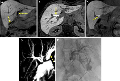 A 46 Year Old Woman With A History Of Hepaticojejunostomy Presents With Download Scientific