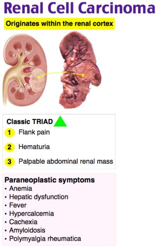 Renal Cell Carcinoma Flashcards Quizlet