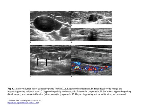 Fig 6 Suspicious Lymph Nodes Ultrasonography Features A Ppt Download