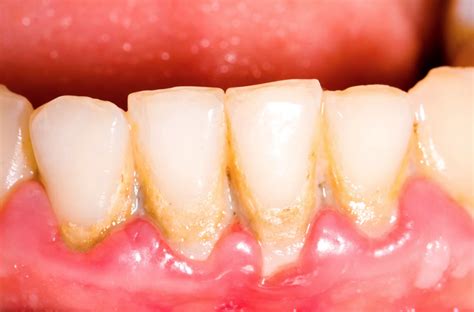 Symptoms Of Gum Disease French Dental Services Drmiski Dubai