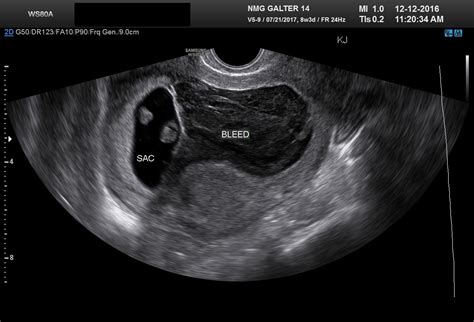 Subchorionic Hematoma Size Chart Ponasa