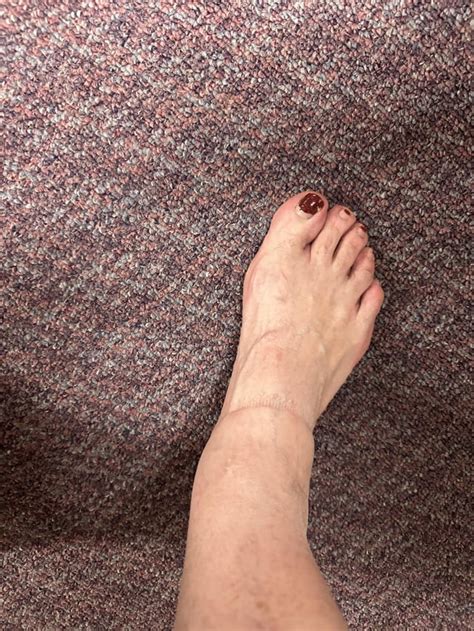 Can This Be A Sign Of Sarcoidosis Pictures Of Severe Swelling In My