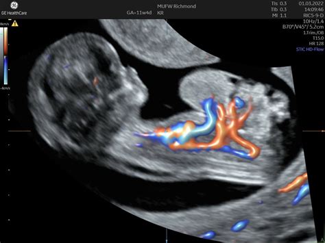 Cloacal Exstrophy At 11w — International First Trimester Symposium 31st