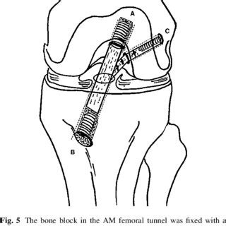 Pdf Arthroscopic Double Bundle Acl Reconstruction Using A Bone