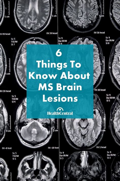 Pin On Multiple Sclerosis Awareness