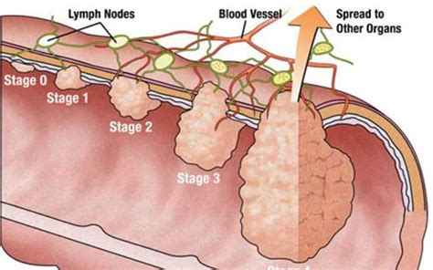 Vulvar Melanoma Staging