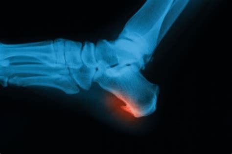Diagnosis And Relief Techniques For Cuboid Syndrome