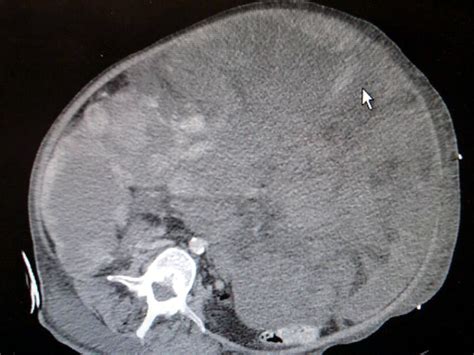 N J Woman Has 51 Pound Tumor Removed During Touch And Go Five Hour
