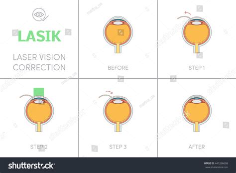 1 Decrease Visual Acuity Stock Vectors Images And Vector Art Shutterstock