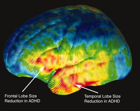 Add Adhd Program Dr Zembroski