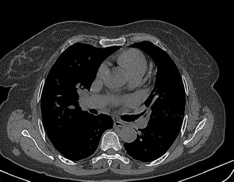 Left Atrial Myxoma Image