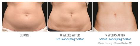 Coolsculpting Double Chin At Dm Cosmetic Clinic Woodbridge Vaughan