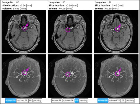 Result Of Cerebral Aneurysm Detection In Mr Angiograms The Upper Download Scientific Diagram