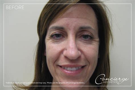Before And After Mommy Makeover Concierge Aesthetics