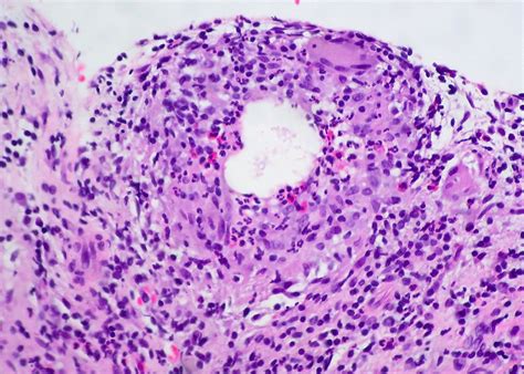 Chalazion