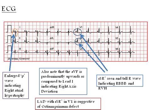 Atrial Septal Defect Ecg