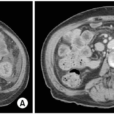 Abdominal Computed Tomography CT A It Shows Diffuse Wall Download Scientific Diagram