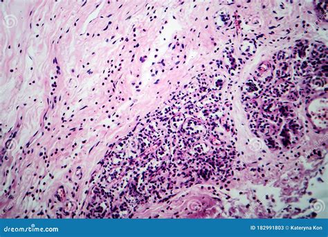 Breast Fibroadenosis Light Micrograph Stock Image Image Of Fibrosis