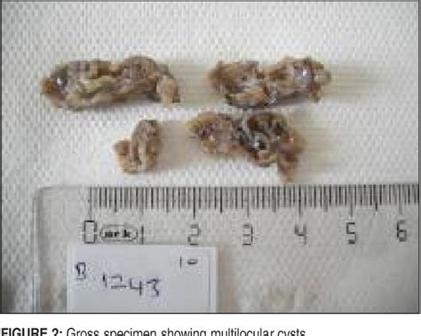 Figure 1 From Endometriosis In The Mesothelial Cyst Of The Round
