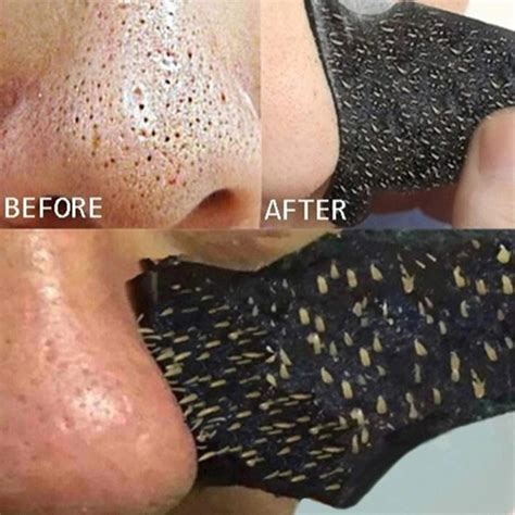 Nose Blackhead Removal Sticker Strips Inspire Uplift