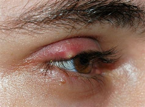 Нулимсны хүүдийн үрэвсэл Дакриоцистит Medbook Mn