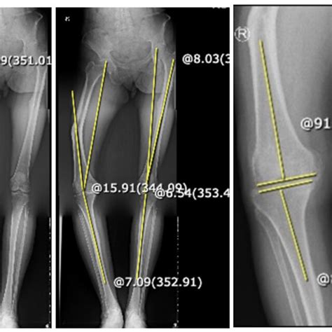 Lower Extremity Scanogram Of The Patient And Preoperative Measurements Download Scientific