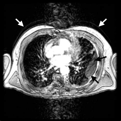 Figure From Automated Lung Segmentation Of Diseased And Artifact Corrupted MR Sections