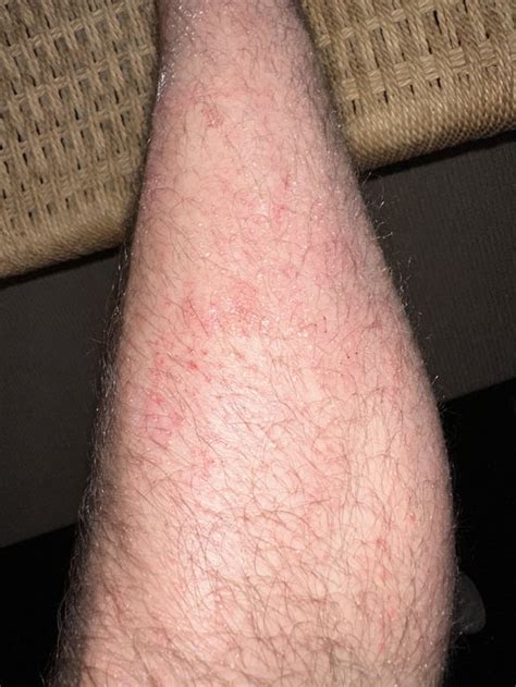 Is This Psoriasis R Psoriasis