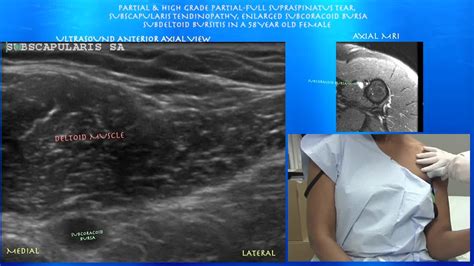 Subcoracoid Bursitis