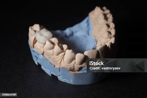 치아의 곰팡이 치아의 석고 모델 석고 치과 및 치열 교정 개념 석고붕대에 대한 스톡 사진 및 기타 이미지 석고붕대 이빨 건강관리와 의술 Istock