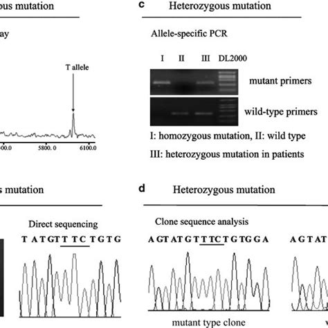 Heterozygous Mutation Of Jak2v617f Detected By Massarray Assay Was