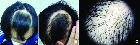 Clinical Characteristics A B Annular Alopecic Patches On Scalp C