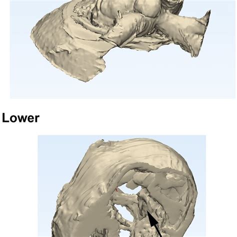 Model Produced From Later Ct Scan Shortly Before Surgery Screenshot Download Scientific