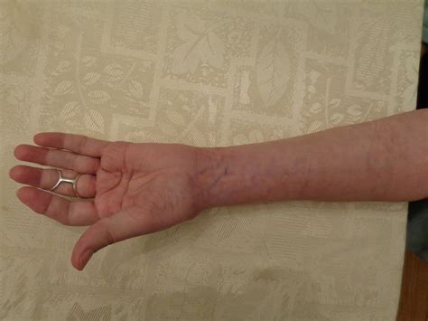 Heres Your Gold Watch Rheutired Wrist Fusion Surgery
