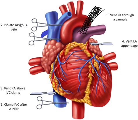 Steps Of The Procedure A Nrp Abdominal Normothermic Regional
