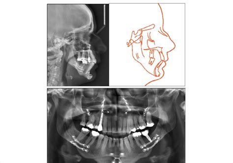 Three Years Post Treatment Cephalogram Tracing And Panoramic