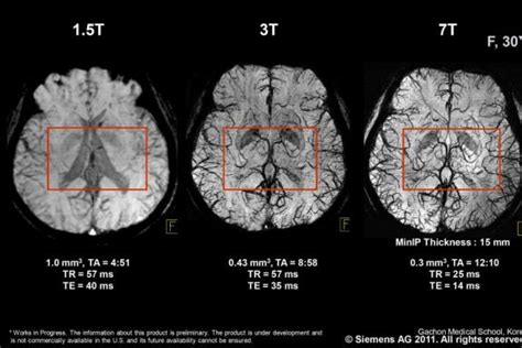 7 T Mri Is It Worth It