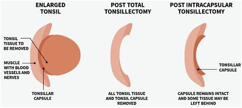 Tonsillectomy And Adenoidectomy Ear Nose And Throat Clinic Of Lufkin