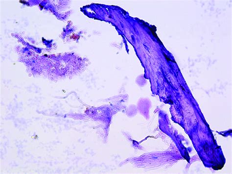 Incapsulated Graft Granules And Granulation Tissue Download