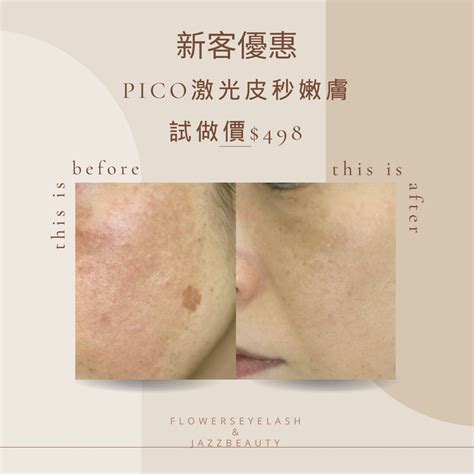 Pico Laser皮秒激光嫩膚去斑療程 美容＆個人護理 健康及美容 皮膚護理 面部 面部護理 Carousell