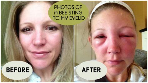 My Experience Of A Bee Sting Near My Eye With Photo Progression