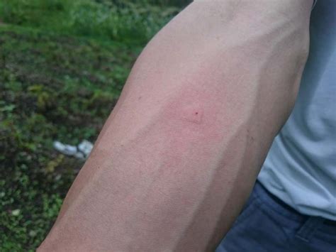 夏は「ブヨ」に注意！刺されたら？刺されないための対策は？ こ、こすげぇー 小菅村の情報発信中！