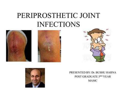 Periprosthetic Joint Infection Pptx