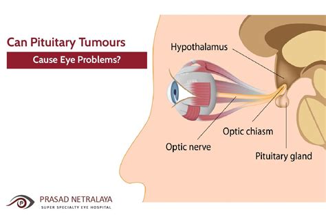 Pituitary Gland Infection