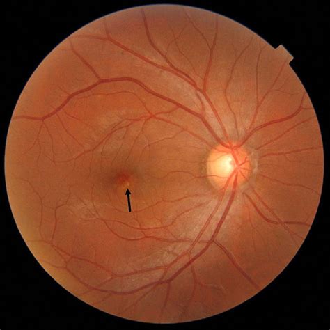 Spectral Domain Optical Coherence Tomography Of Subfoveal Drusenoid